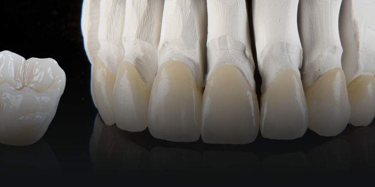 Porcelain Fused To Metal & Cast Gold Crowns | Richardson,TX