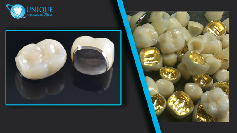 Top 5 things to know about porcelain fused to metal. | Blog